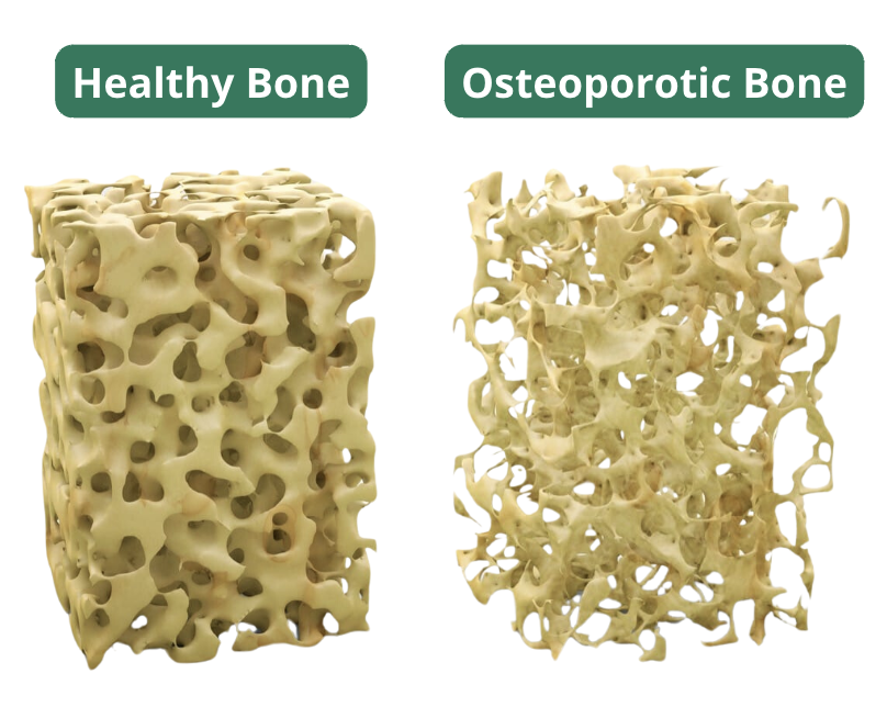 How to Improve Your Bone Health Using DEXA Scans - Ideal DEXA Clinic